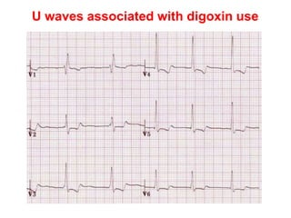 U WAVE IN ECG AND ITS ABNORMALITIES IN ECG | PPTX