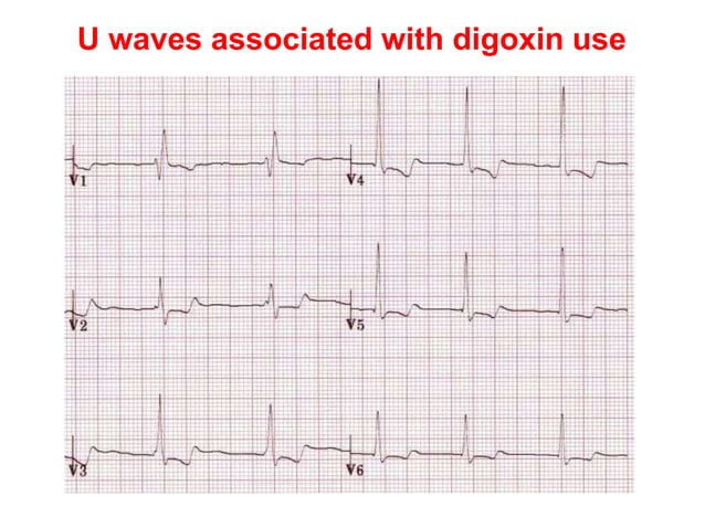 U WAVE IN ECG AND ITS ABNORMALITIES IN ECG | PPTX | Heart and ...