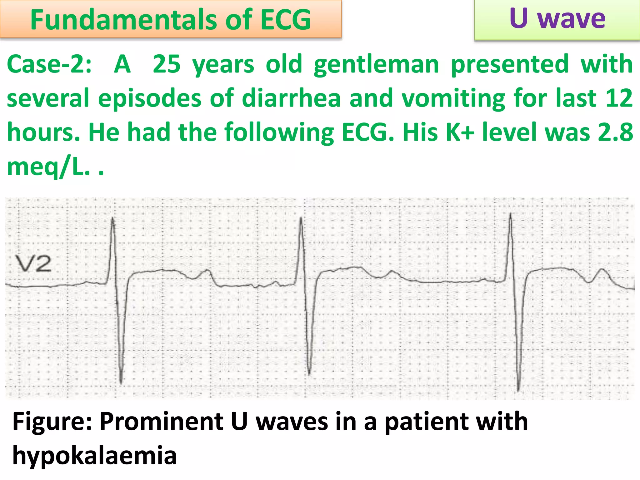 Approach to a patient with U wave in ECG | PPSX