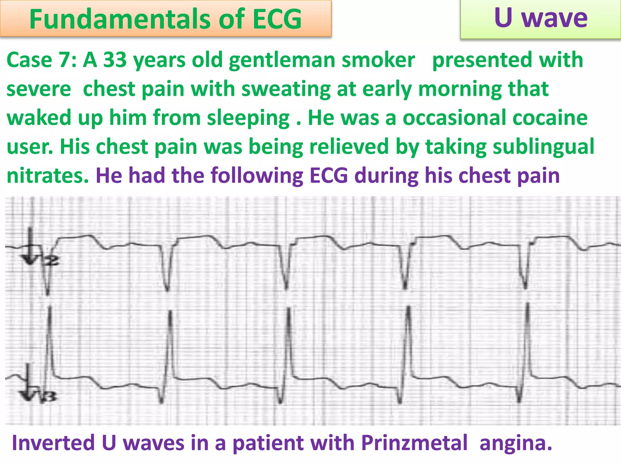 Approach to a patient with U wave in ECG | PPSX