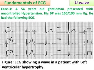 Approach to a patient with U wave in ECG | PPSX