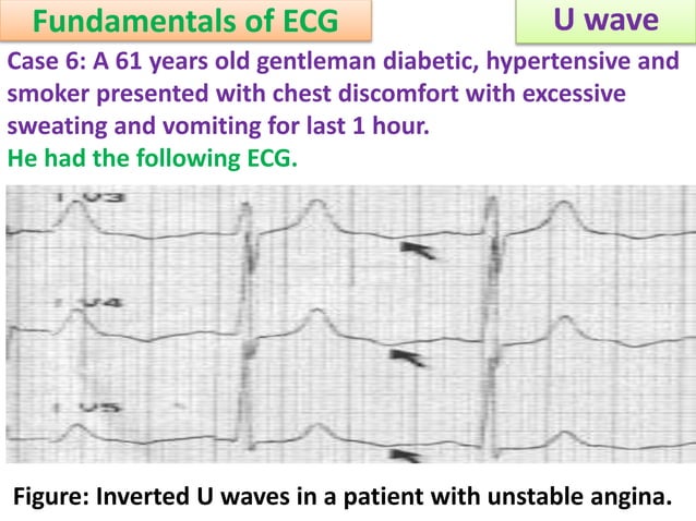 Approach to a patient with U wave in ECG | PPSX | Heart and ...