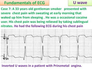 Approach to a patient with U wave in ECG | PPSX