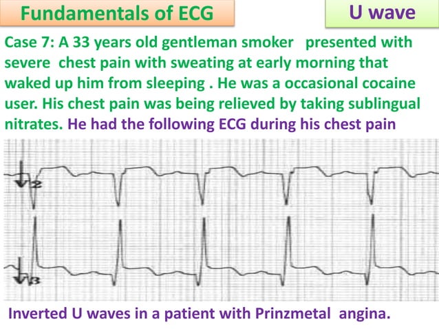 Approach to a patient with U wave in ECG | PPSX | Heart and ...