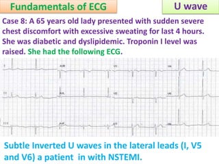 Approach to a patient with U wave in ECG | PPSX