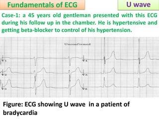 Approach to a patient with U wave in ECG | PPT