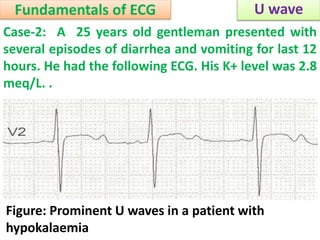 Approach to a patient with U wave in ECG | PPT