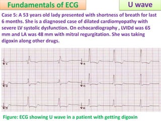 Approach to a patient with U wave in ECG | PPT