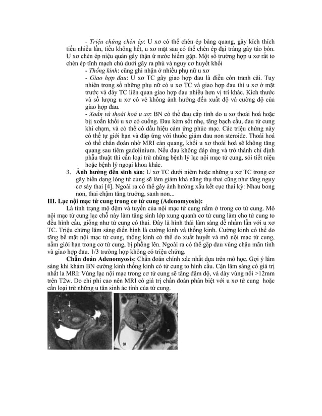 U XƠ TỬ CUNG | PDF