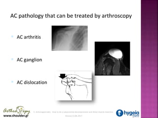 How to do a sd & a dc resection | PPTX