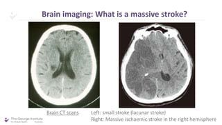 Massive Stroke by Dr Candice Delcourt | PPTX
