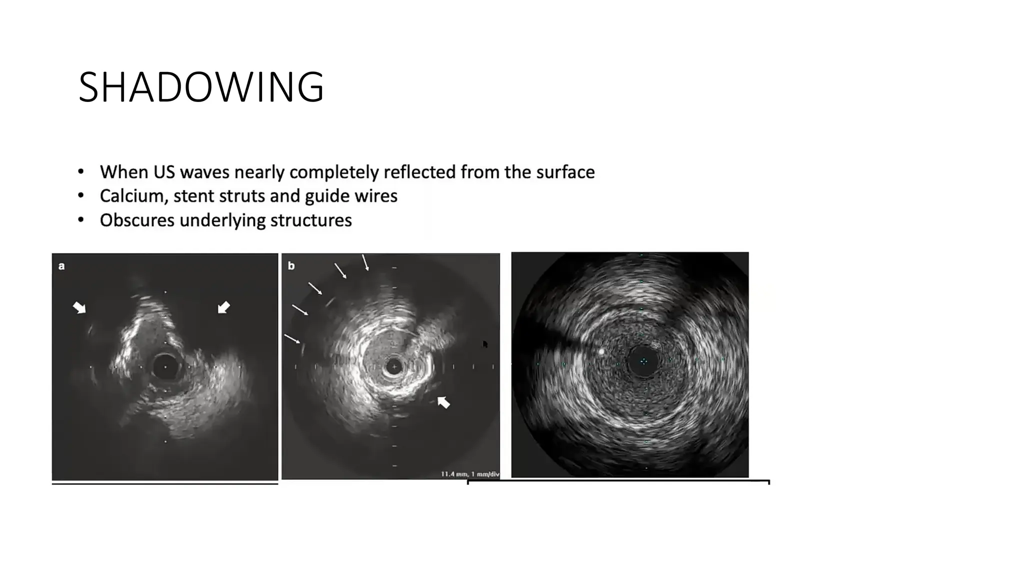 IVUS, Cardiology. postgraduate levelpptx | PPTX