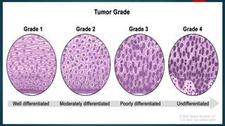 TUMORS and Types of tumors, General biology of tumors, Spread of ...