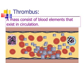 V. Hyper Coagulation State | PPT