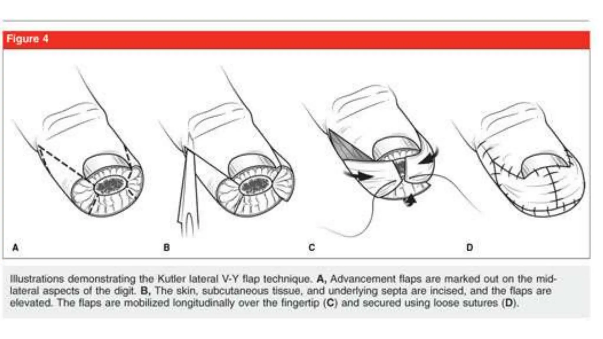 V-Y Advancement flap - for Fingertip amputations | PPTX