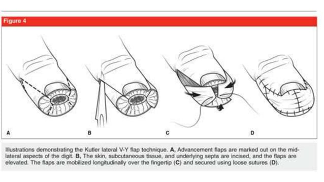 V-Y Advancement flap - for Fingertip amputations | PPTX | Death, Injury ...