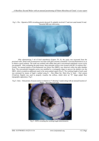A Maxillary Second Molar with an unusual positioning of ...