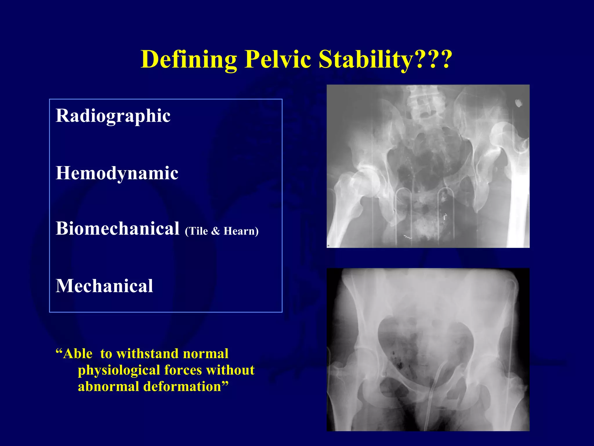 V02 pelvis acute_mgmt | PPT