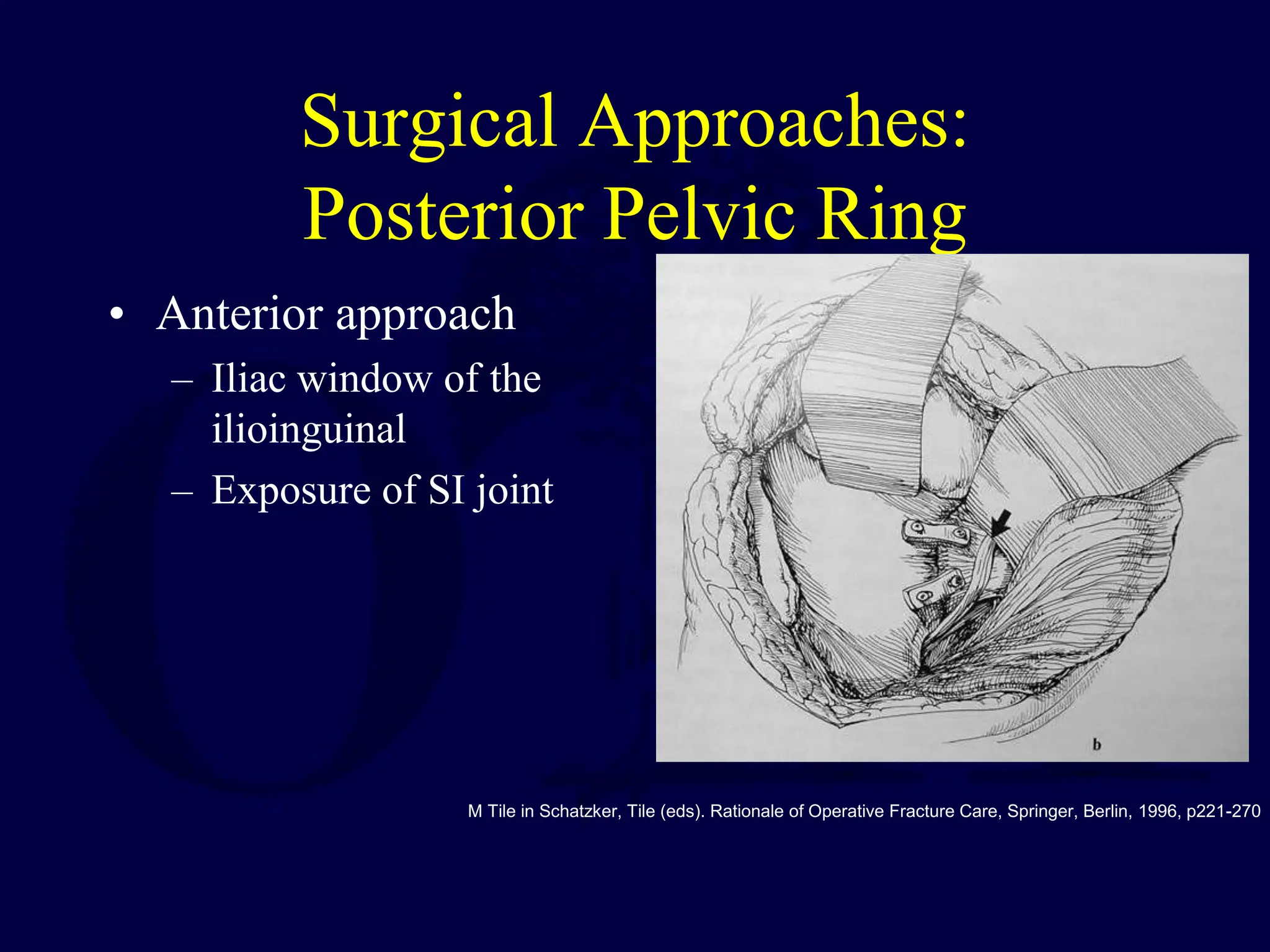 pelvis fractures definitive management.ppt