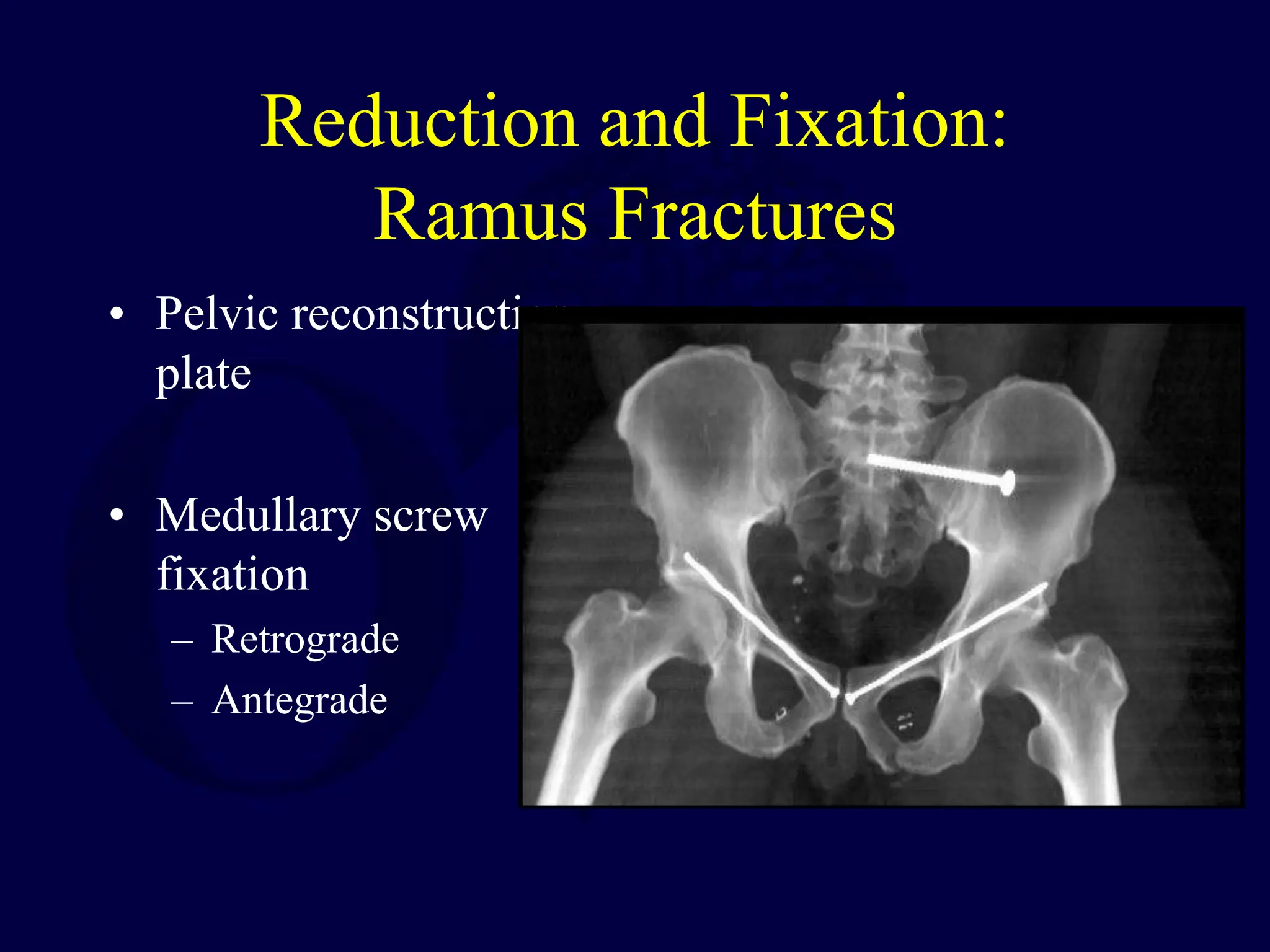 pelvis fractures definitive management.ppt