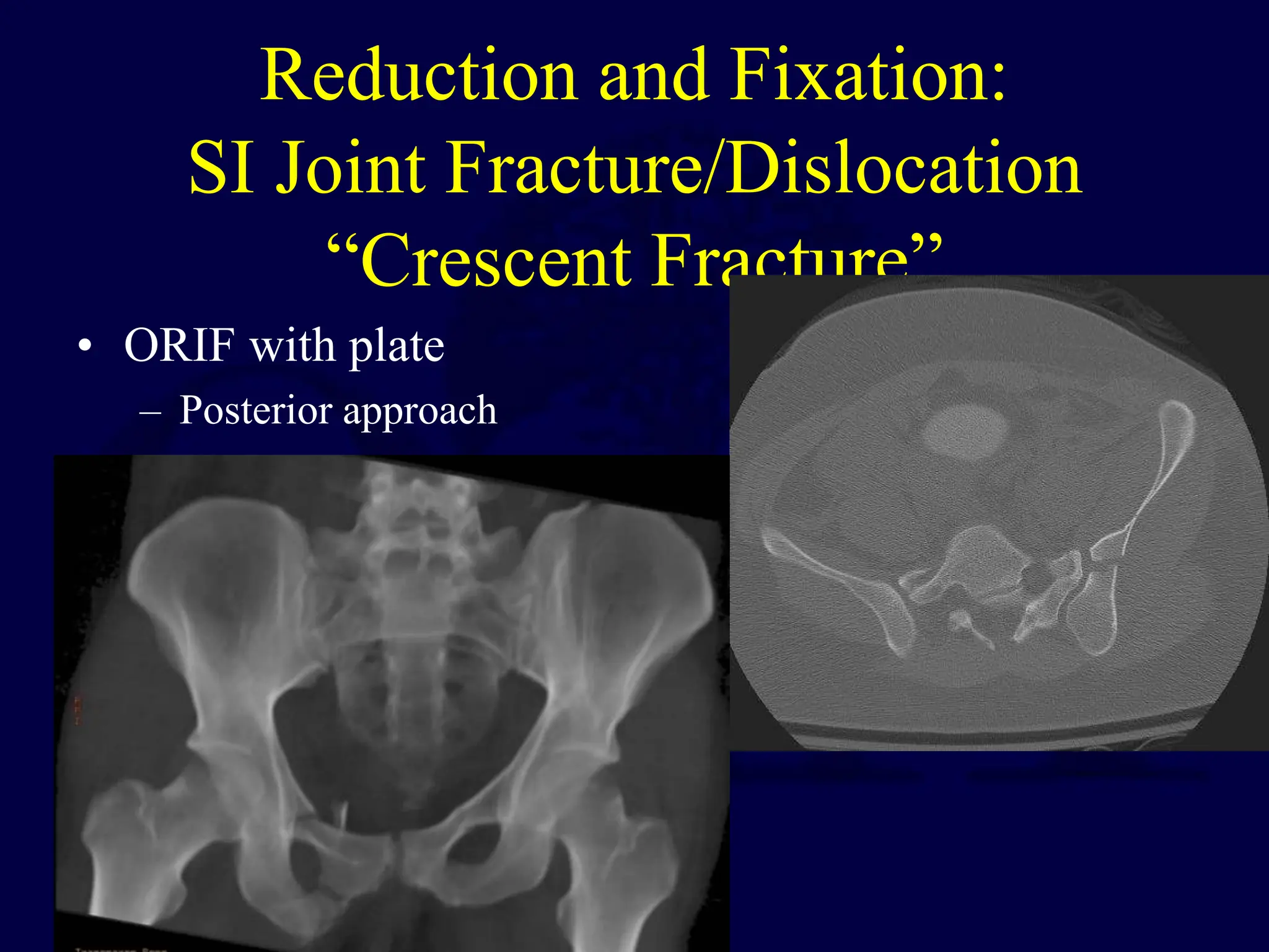 pelvis fractures definitive management.ppt