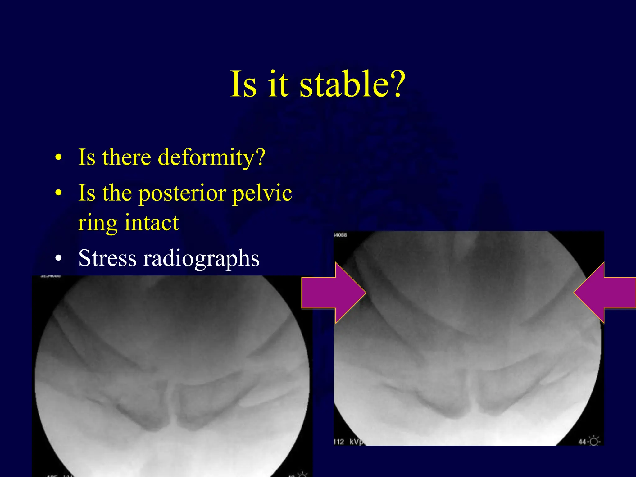 pelvis fractures definitive management.ppt