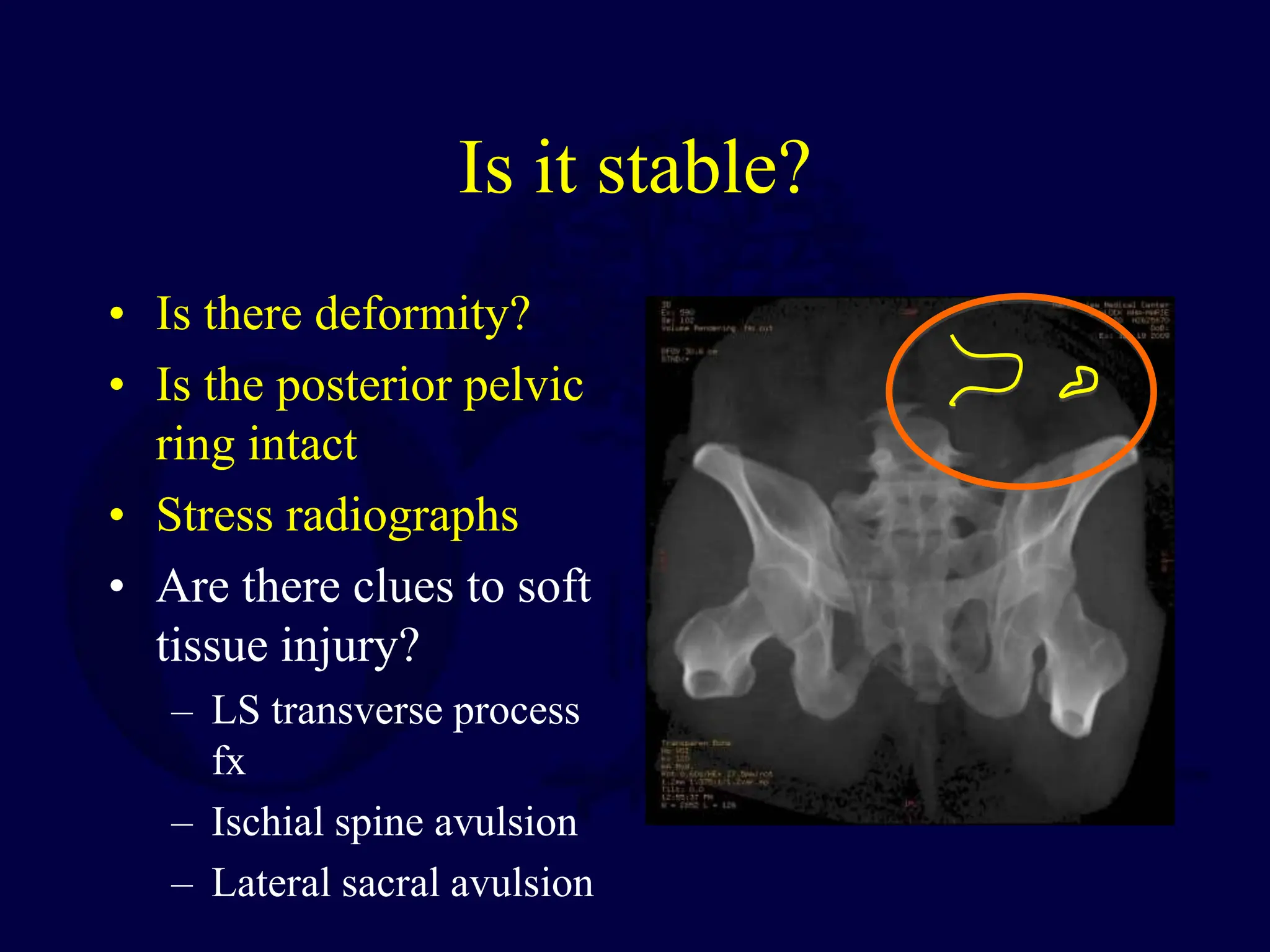 pelvis fractures definitive management.ppt