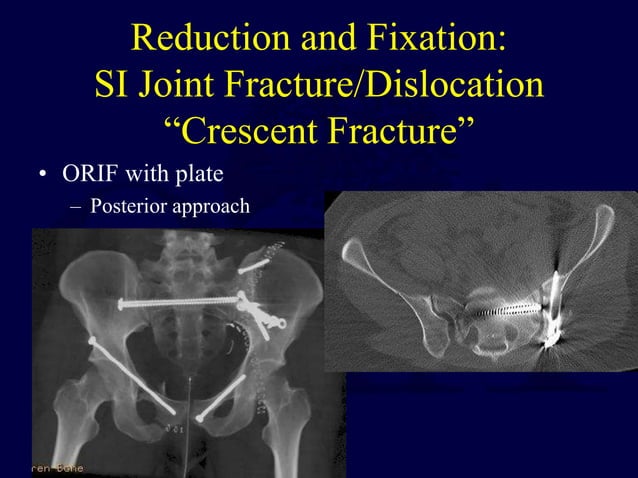 pelvis fractures definitive management.ppt