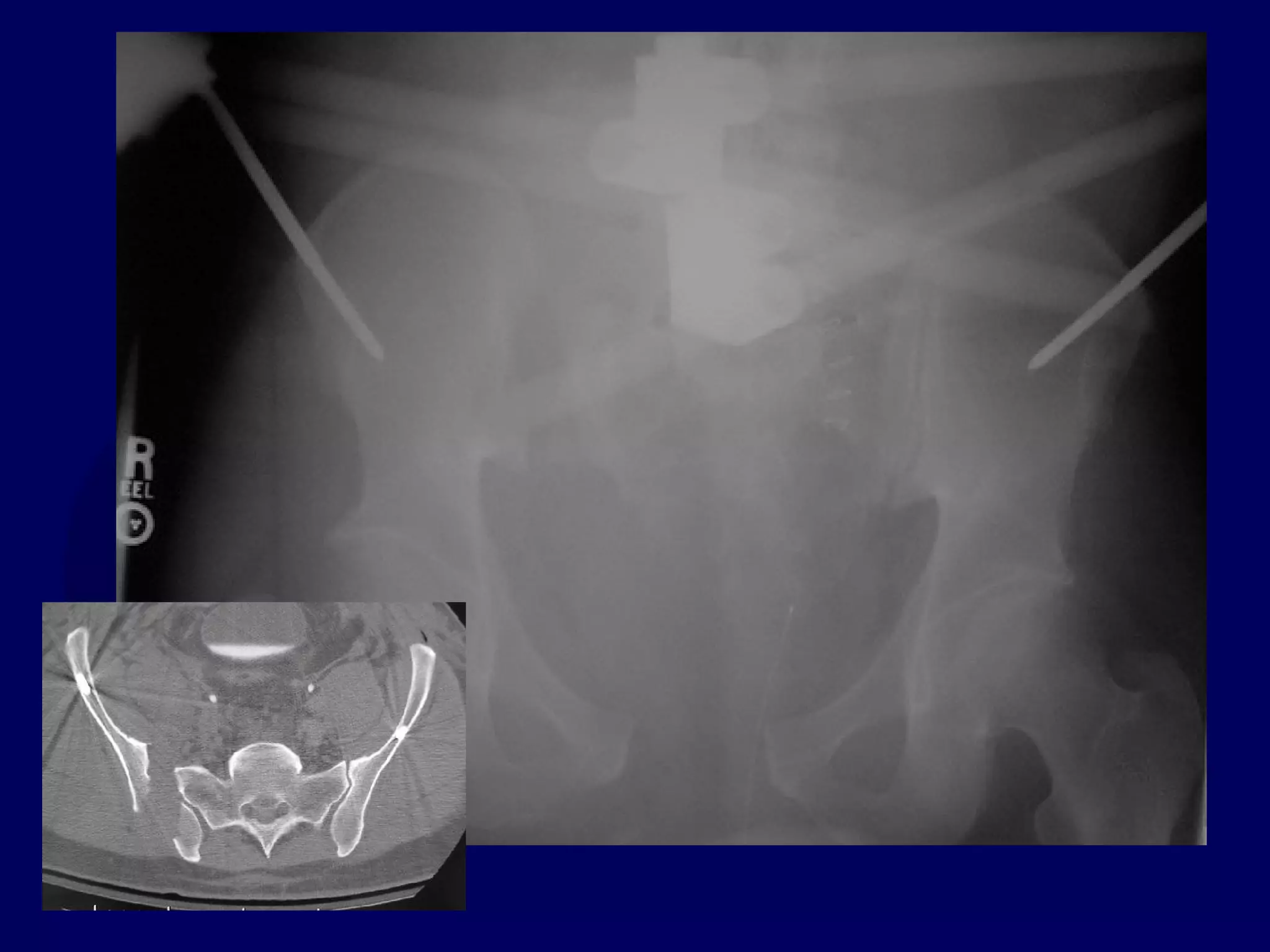 V03 orif pelvic_ring | PPT