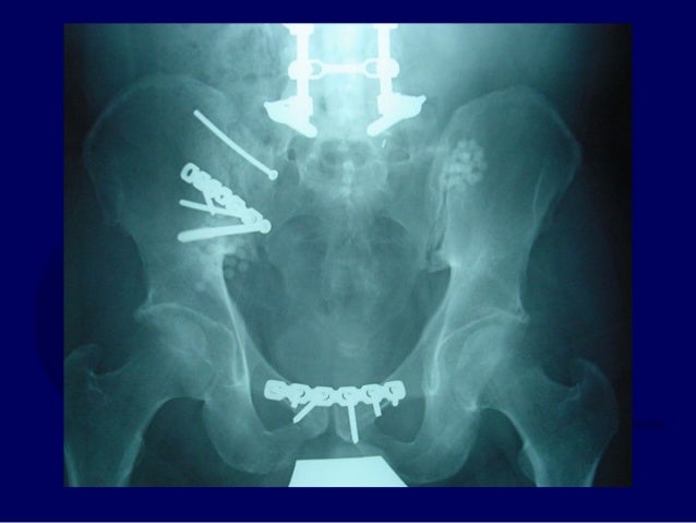 V03 orif pelvic_ring