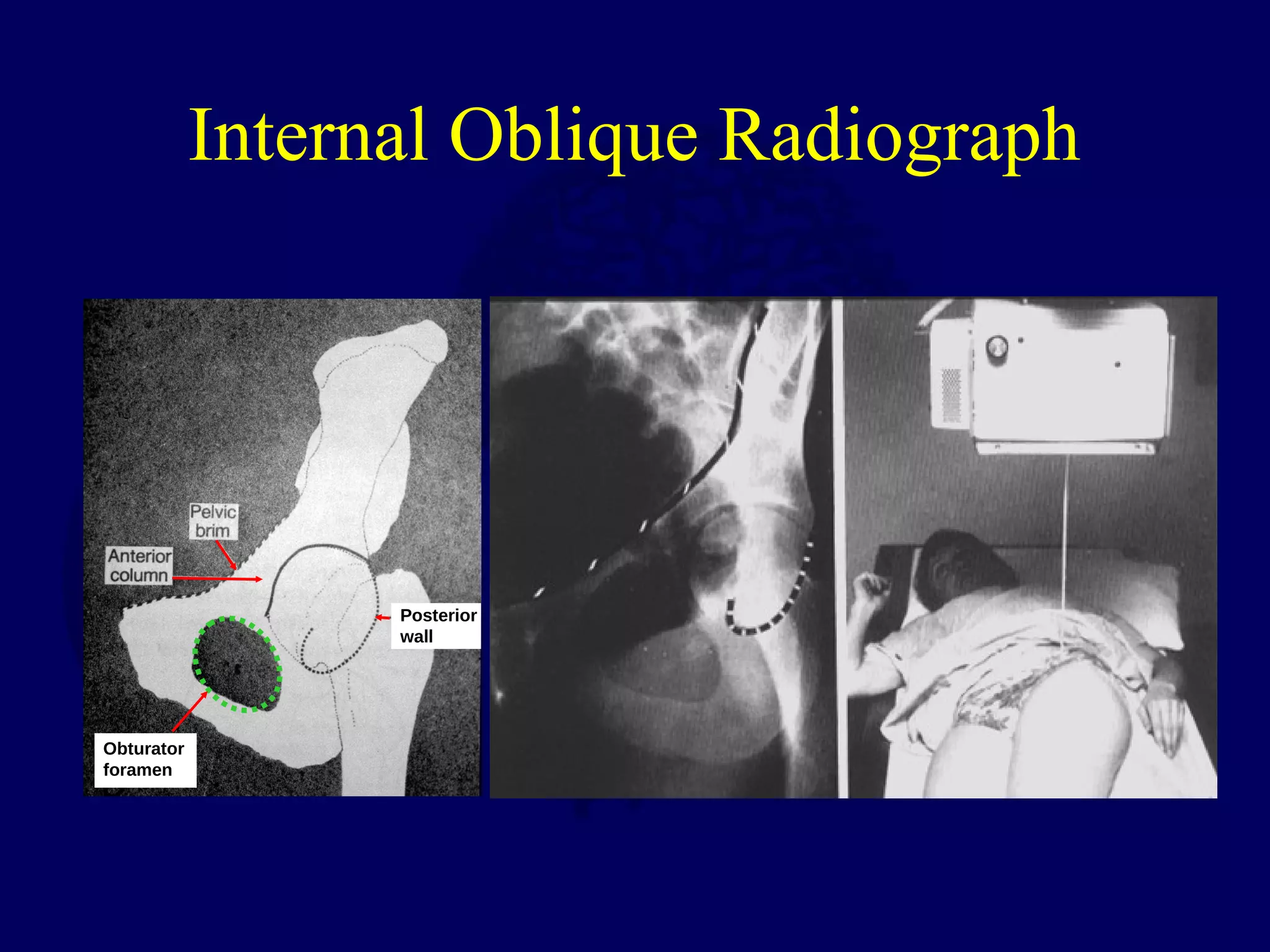 V04 anatomy class_acetab | PPT