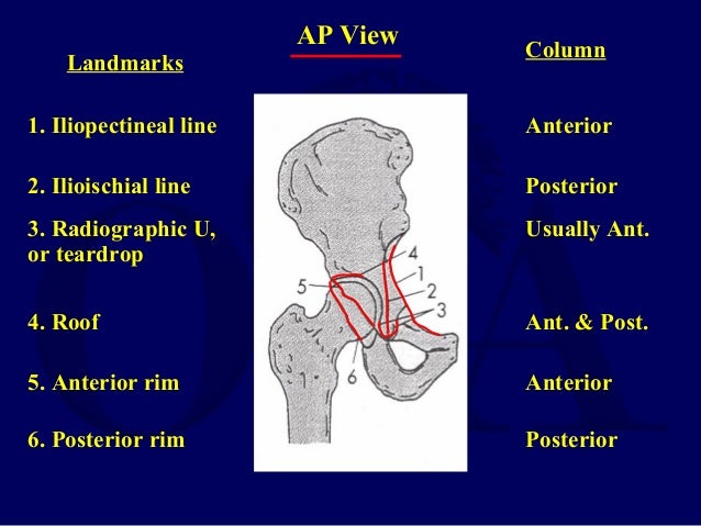Iliopectineal