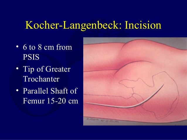 V05 acetab surgical_apprch