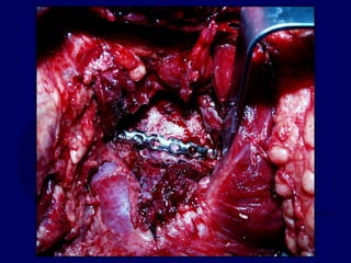 V06 orif acetabulum | PPT
