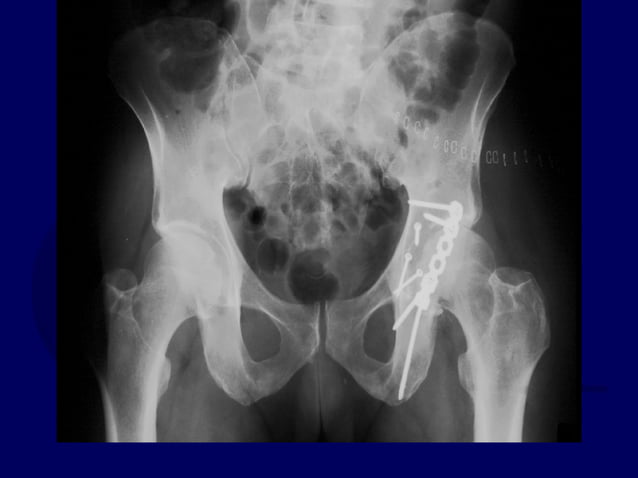 V06 orif acetabulum | PPT