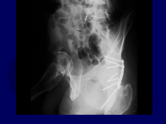 V06 orif acetabulum | PPT