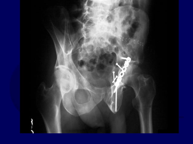 V06 orif acetabulum | PPT