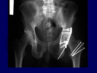 V06 orif acetabulum | PPT