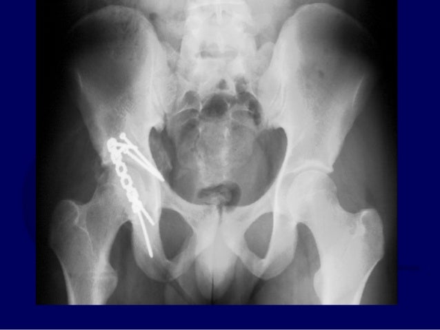V06 Orif Acetabulum