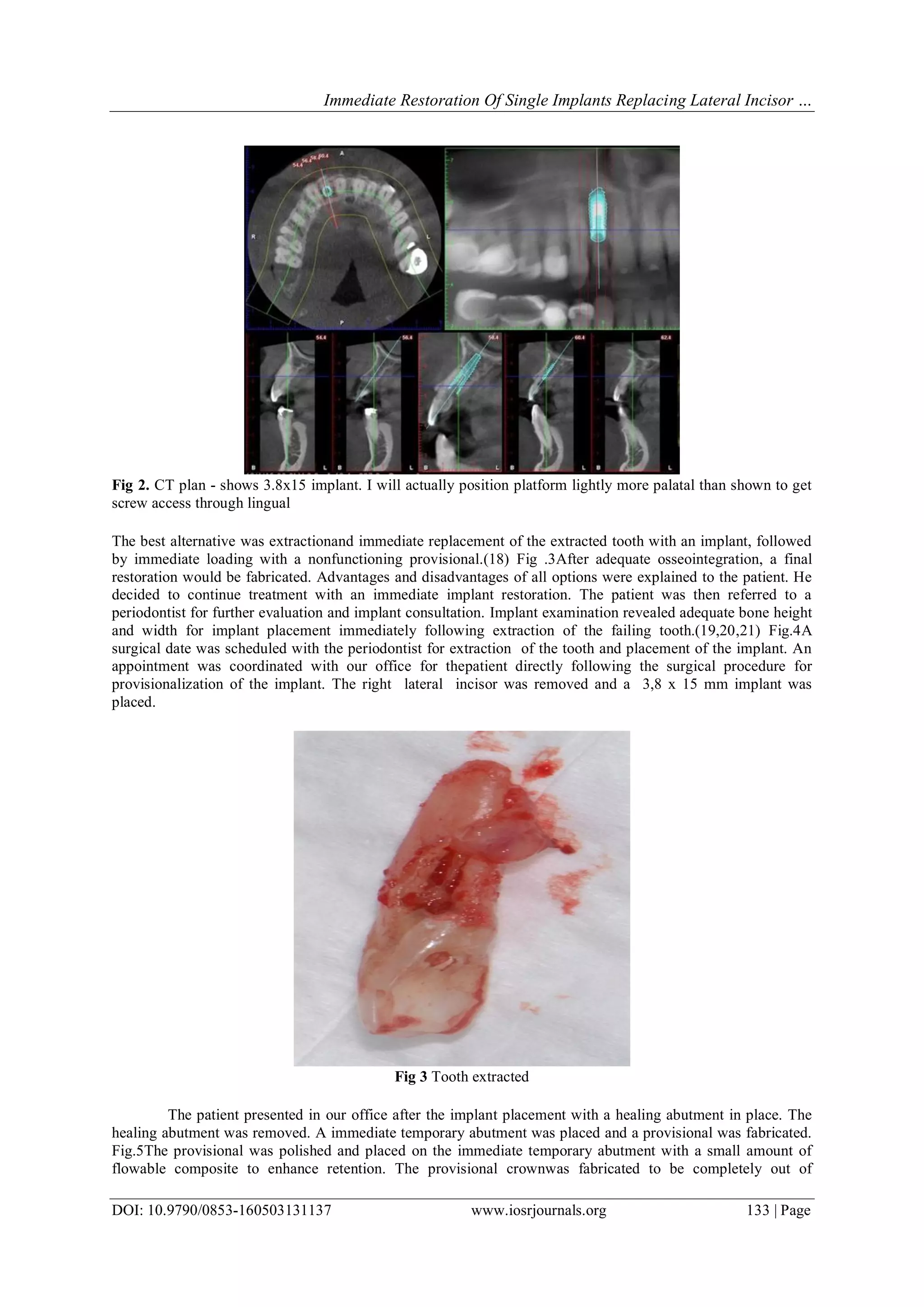 Immediate Restoration of Single Implants Replacing Lateral Incisor ...
