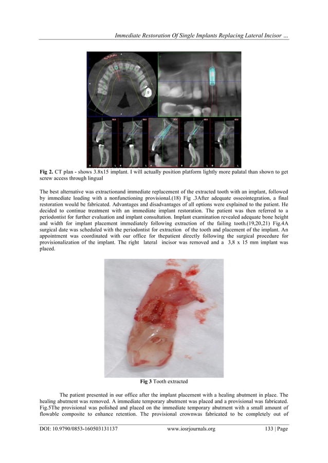 Immediate Restoration of Single Implants Replacing Lateral Incisor ...