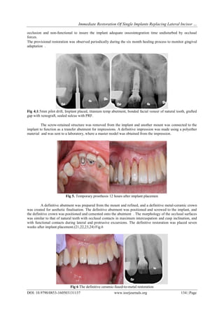 Immediate Restoration of Single Implants Replacing Lateral Incisor Compromised by Internal ...