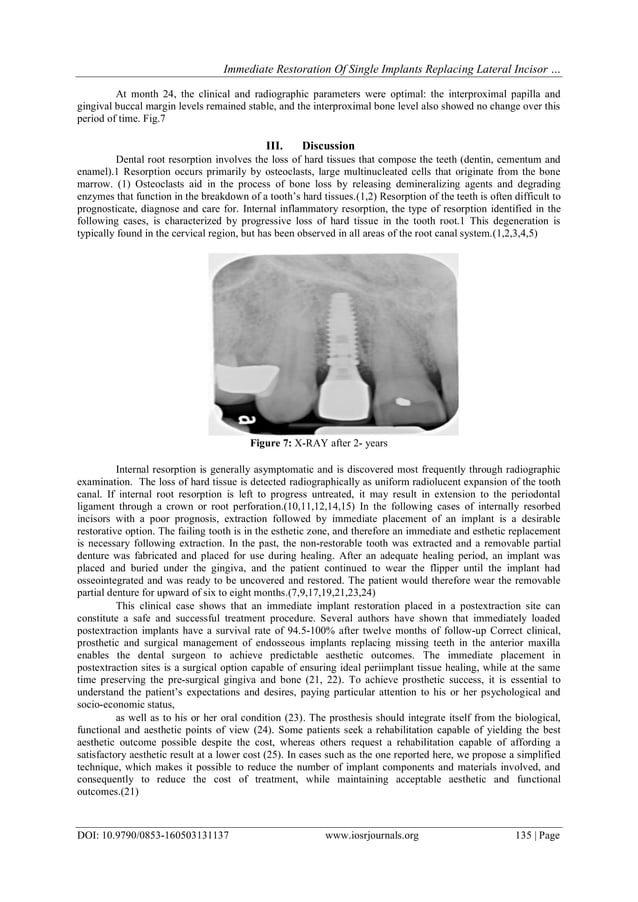 Immediate Restoration of Single Implants Replacing Lateral Incisor ...