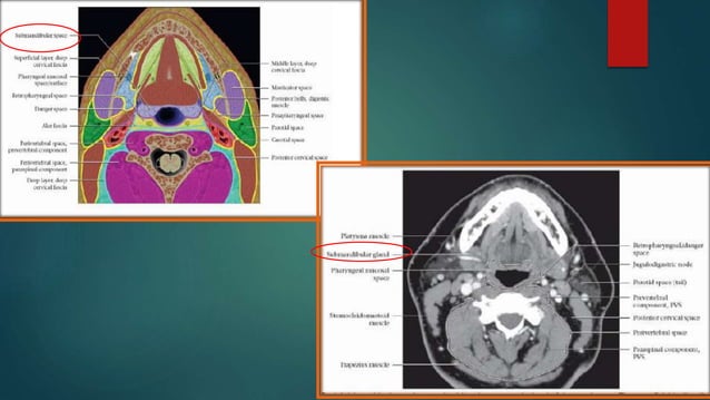 Anatomy of neck spaces | PPTX