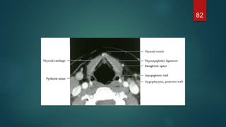 Anatomy of neck spaces | PPTX