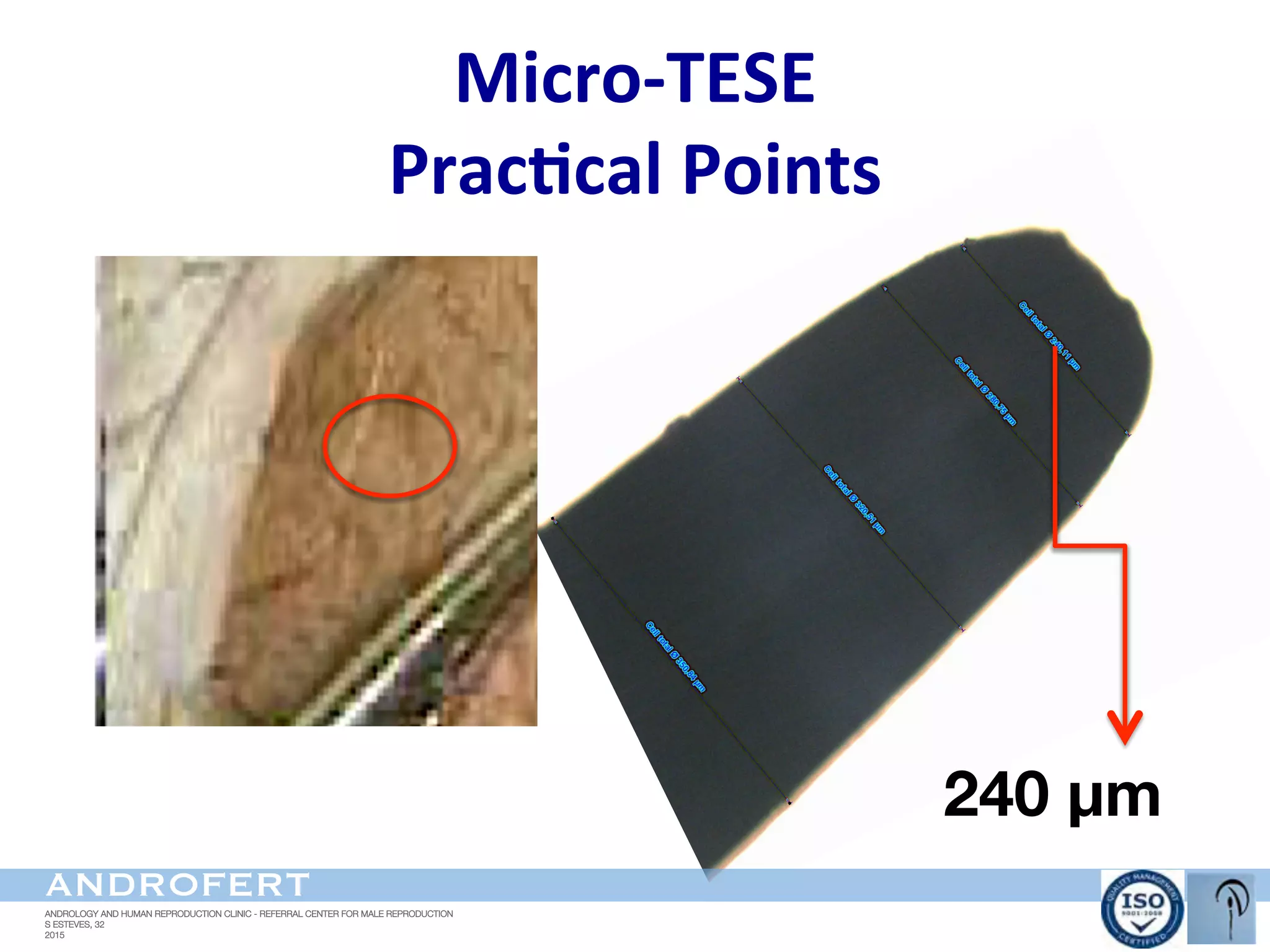 Role of microsurgery in male infertility | PDF