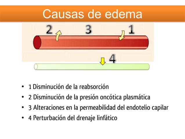 V4 b signos y síntomas, fisiopatología de los diferentes tipos de edema ...