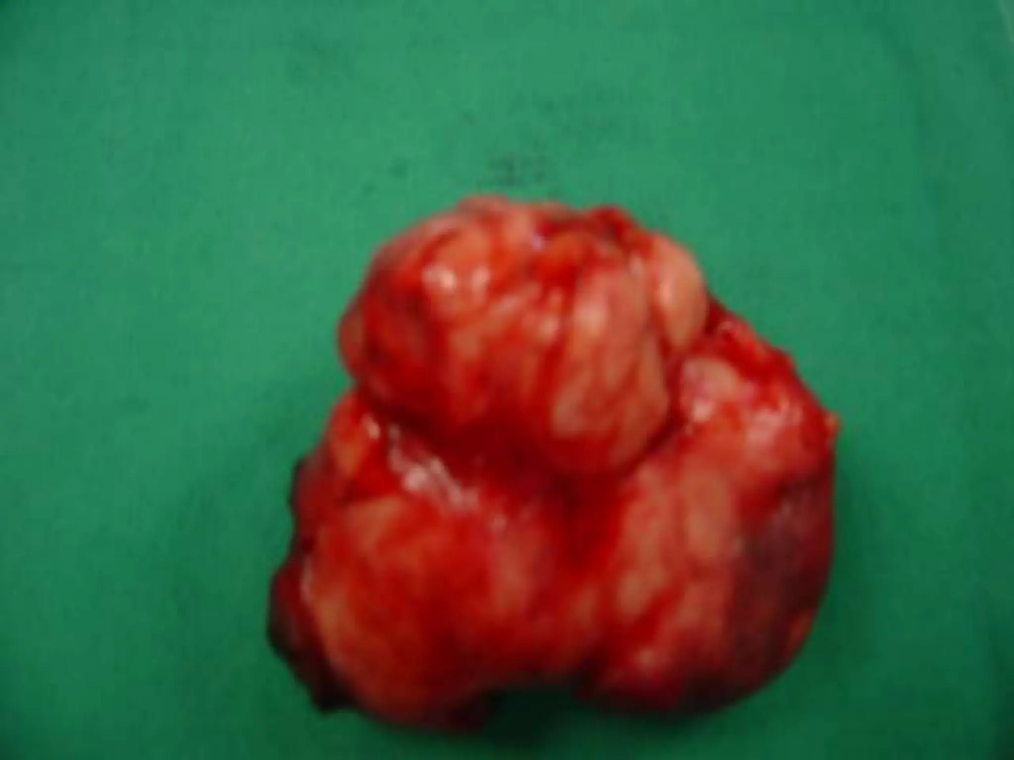 saliv_gland_tumors.pptxg kamel Kalam Kalam | PPTX