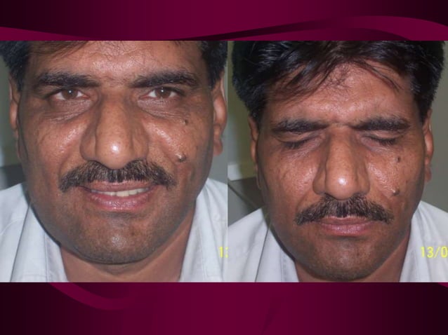 saliv_gland_tumors.pptxg kamel Kalam Kalam | PPT
