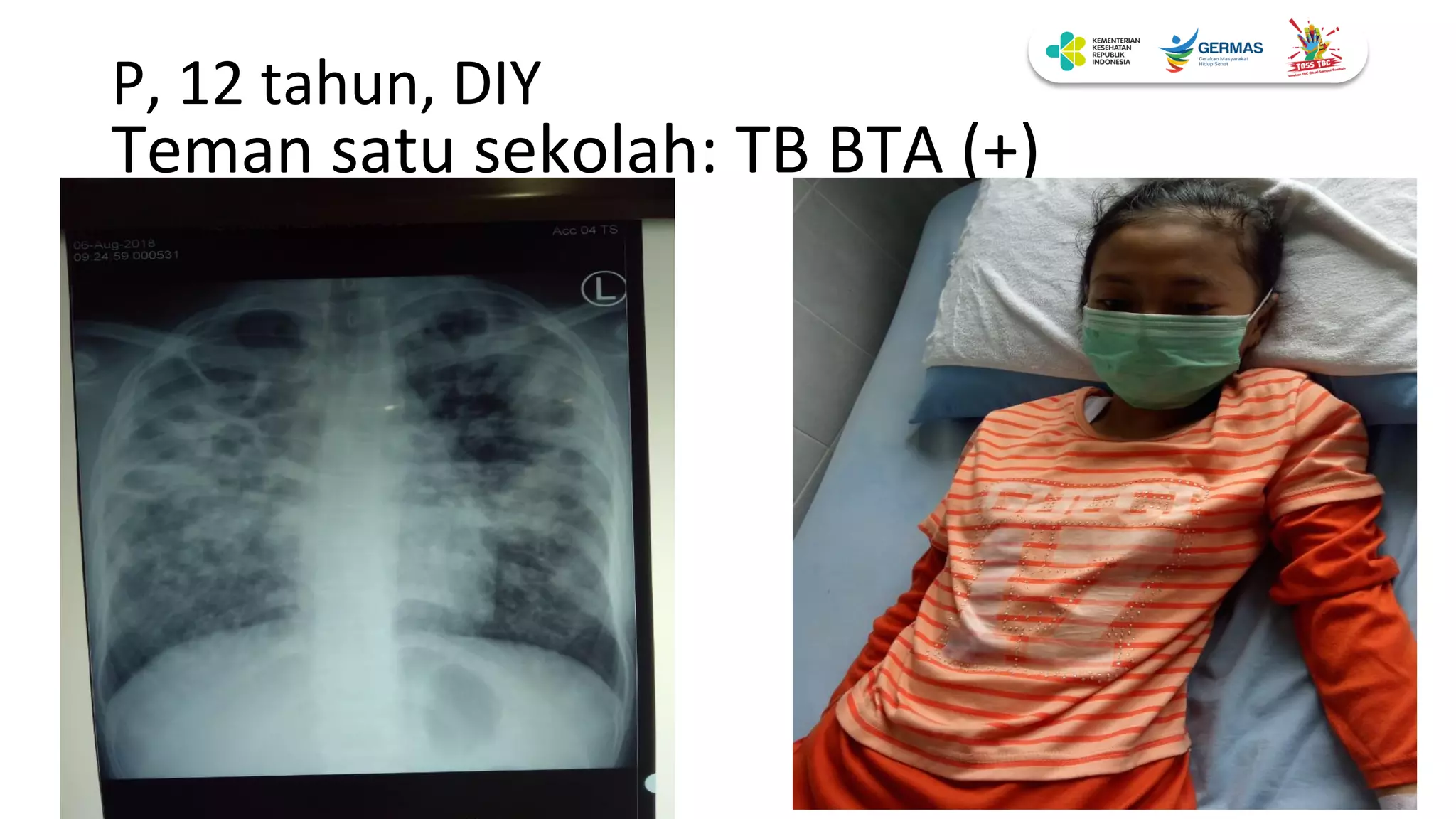 V5_Peserta_Final_Paparan 5_Pemberian Terapi Pencegahan TBC OK.pdf